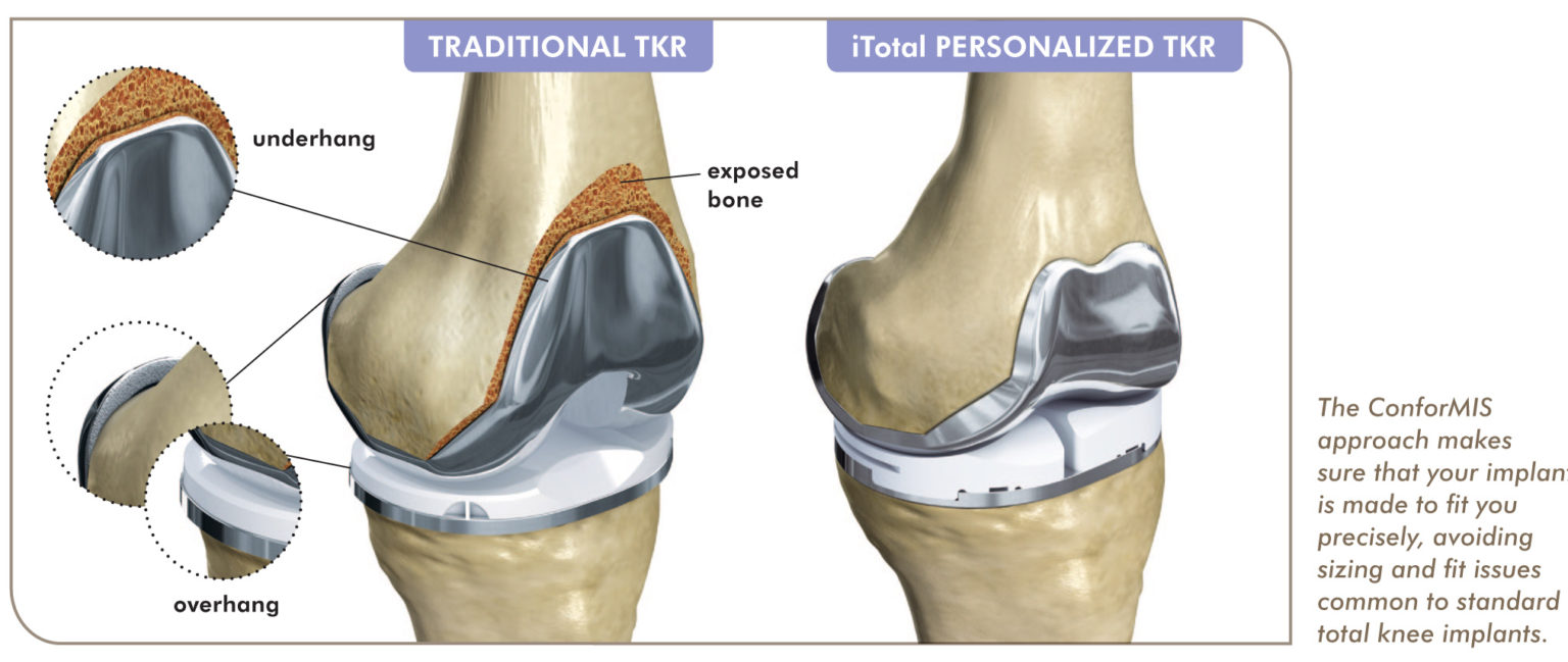 Different Kinds of Knee Replacements | Phoenix Hospital Group